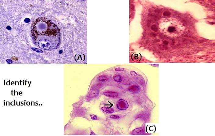 Cowdry Type B Inclusion Bodies