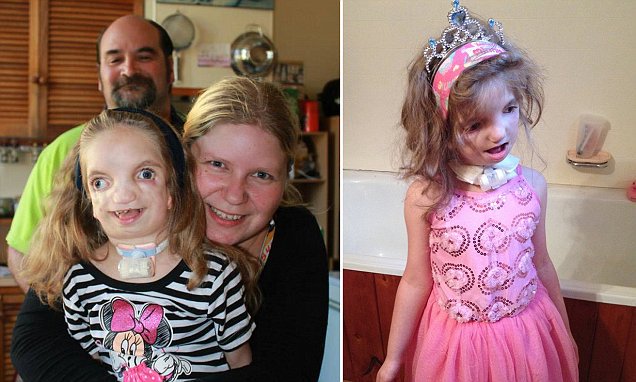 Parents of little girl with rare facial deformity reveal the hurtful ...