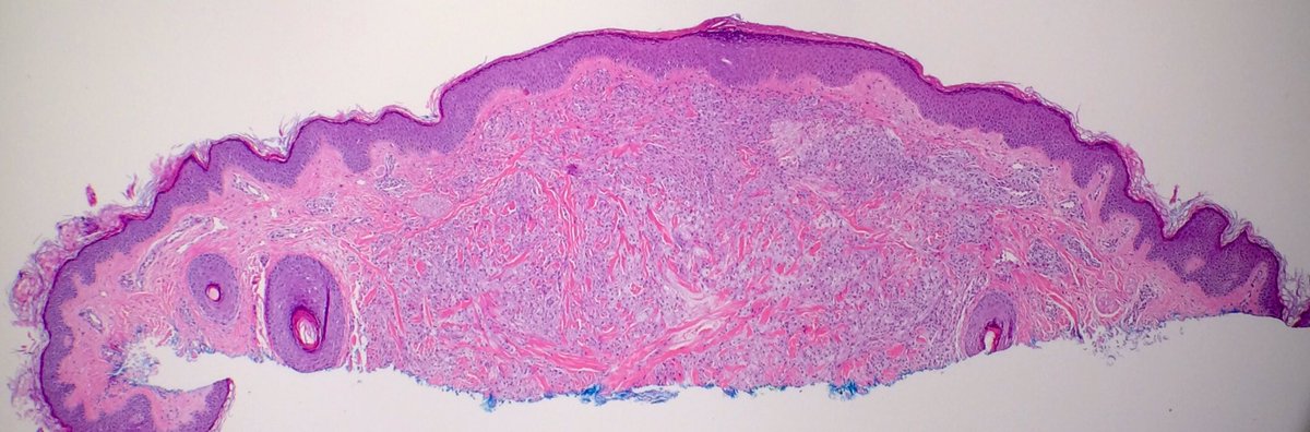 Eruptive Xanthomas Histology