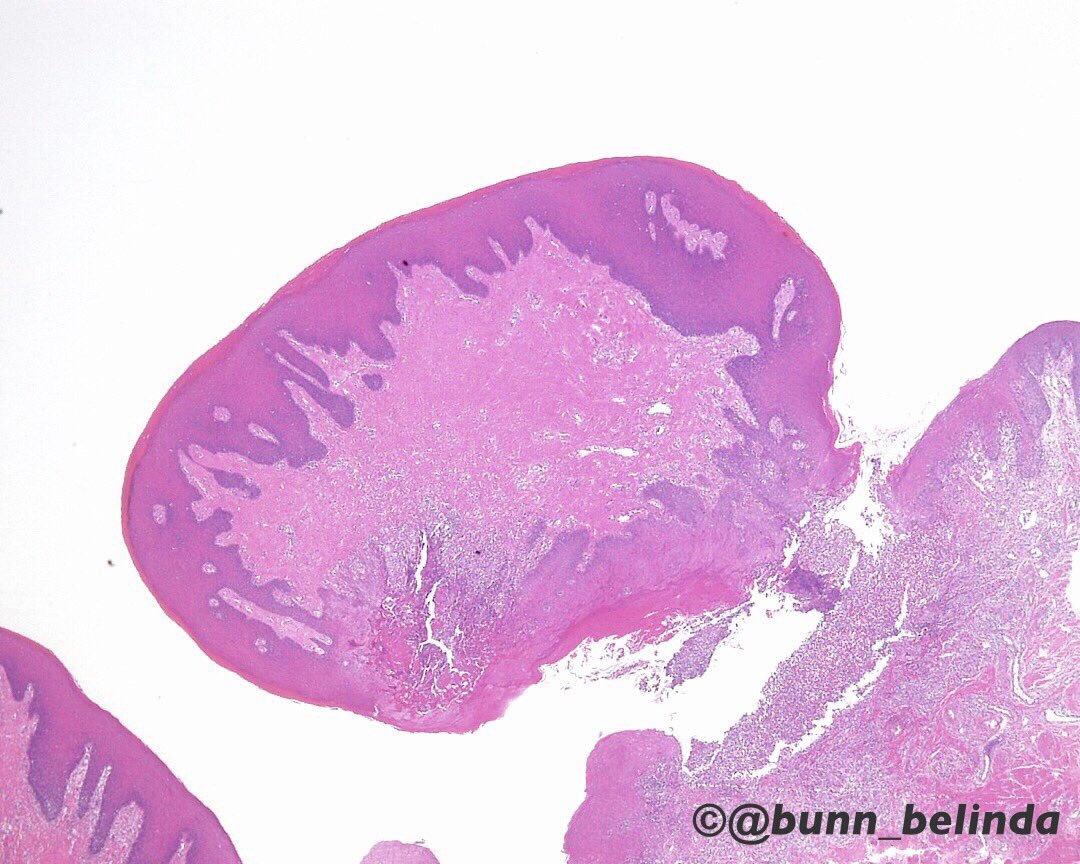 Irritation Fibroma Histology