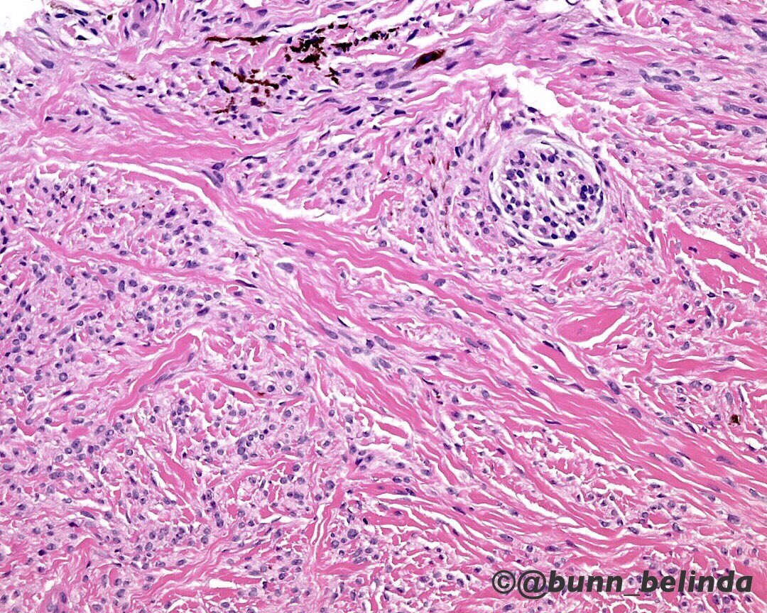 Blue Nevus Histology