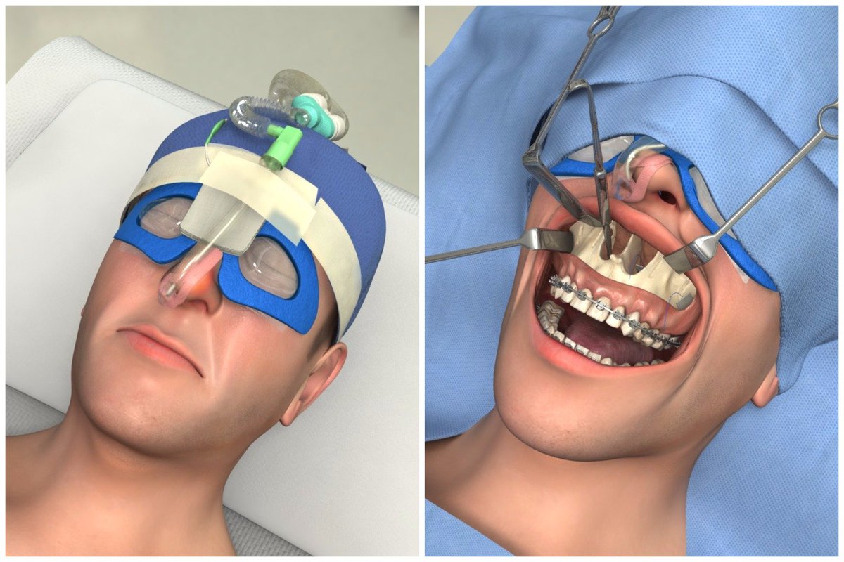 Lefort Procedure