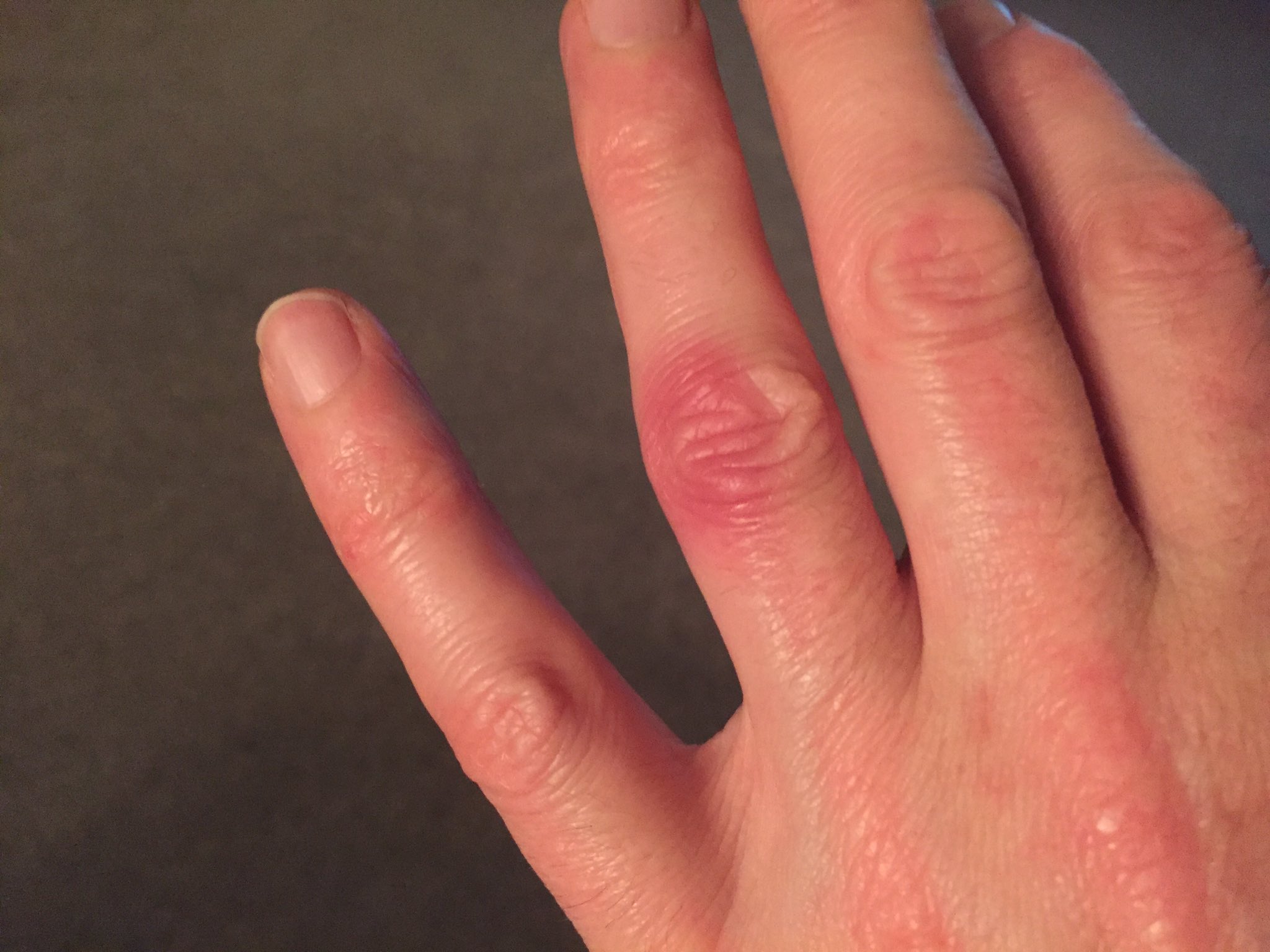 Spider Bite On Finger