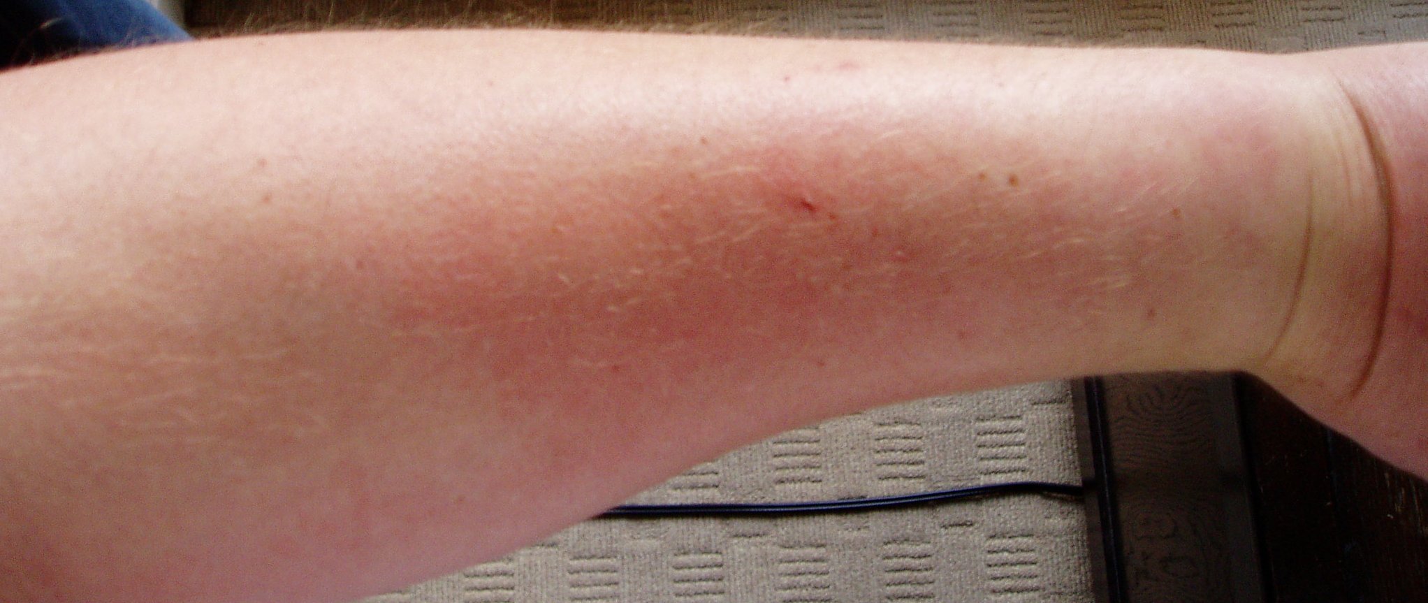 Bee Sting Arm