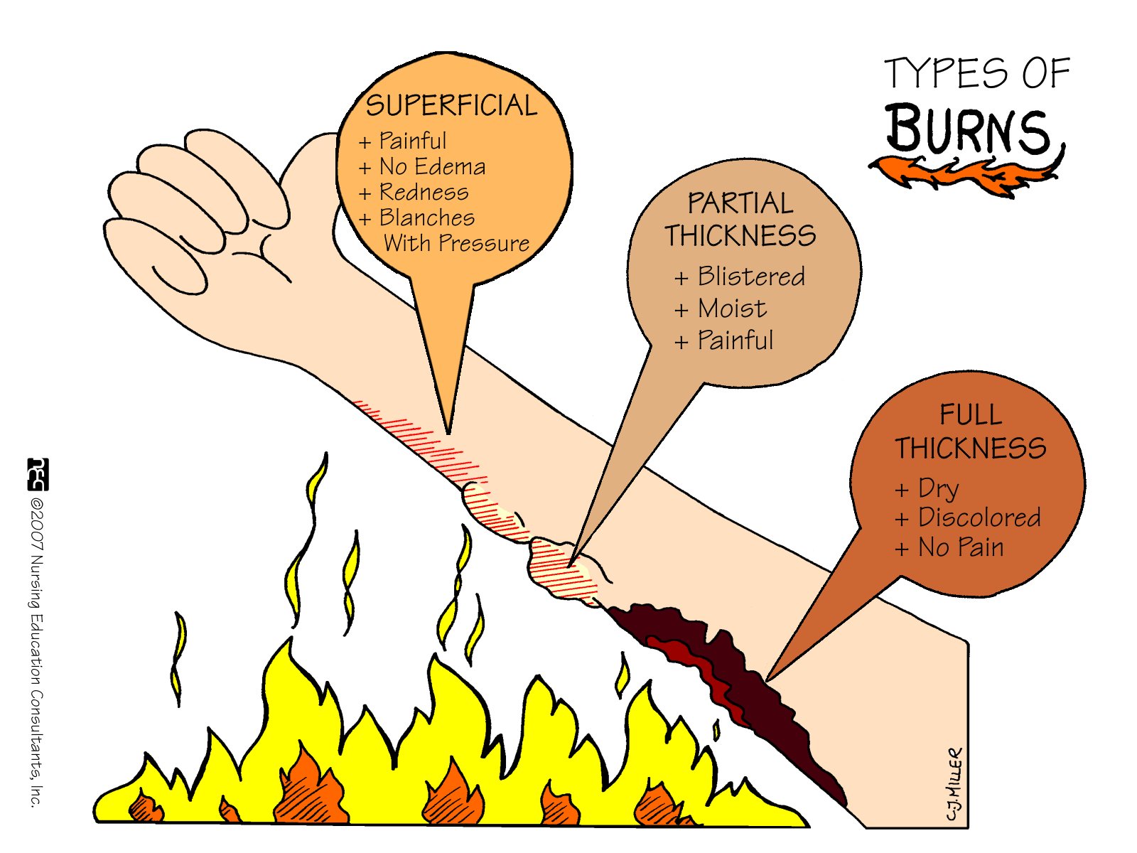 What Do 1st 2nd And 3rd Degree Burns Look Like A Visual First Aid For