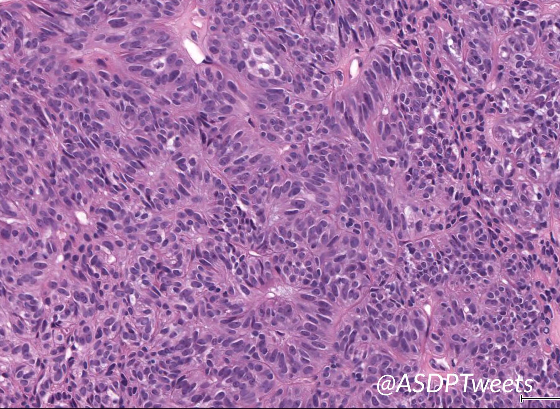 Trichoblastoma Histology