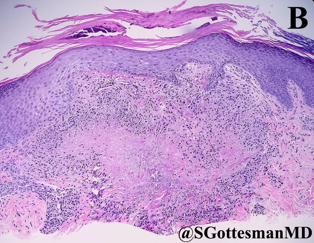 Granuloma Annulare Face