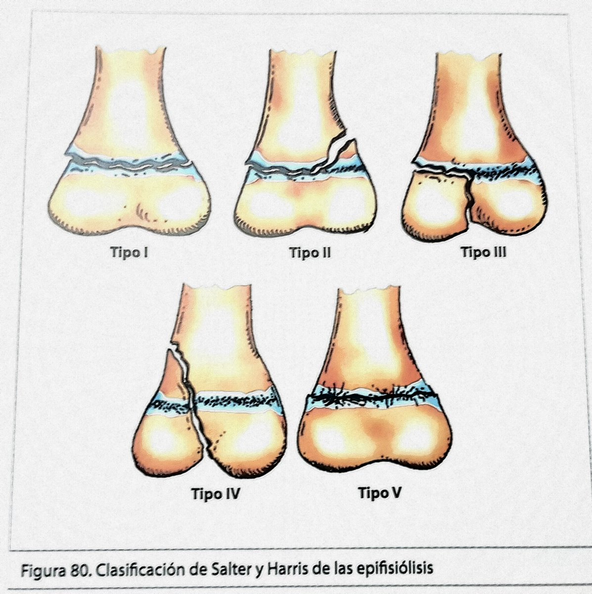 EPIFISIOLISIS CLASIFICACION PDF epifisiolisis-clasificacion-pdf