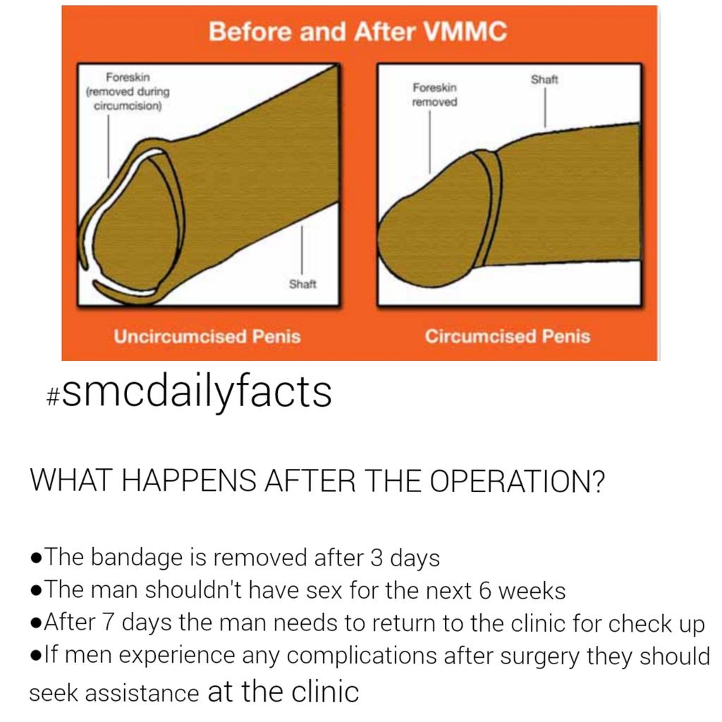 Circumcised Before And After