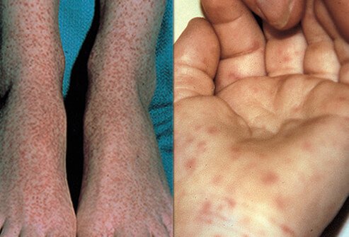 Rocky Mountain Spotted Fever Rash