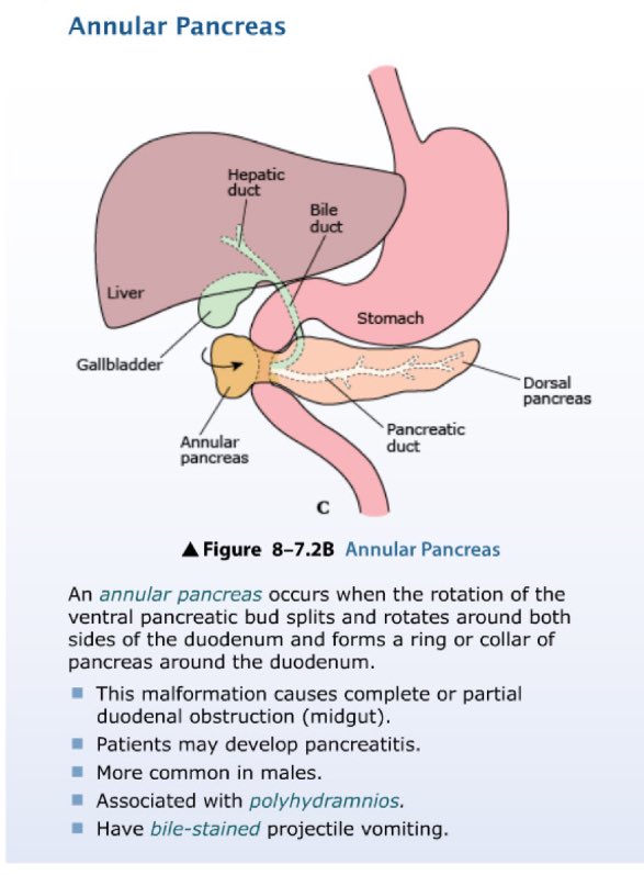Annular Pancreas Embryology