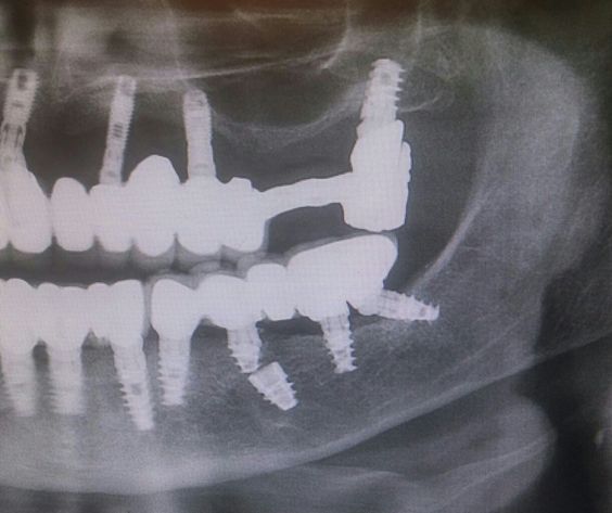 Howard Farran On Twitter Planning Implants Crown Down Https T Co