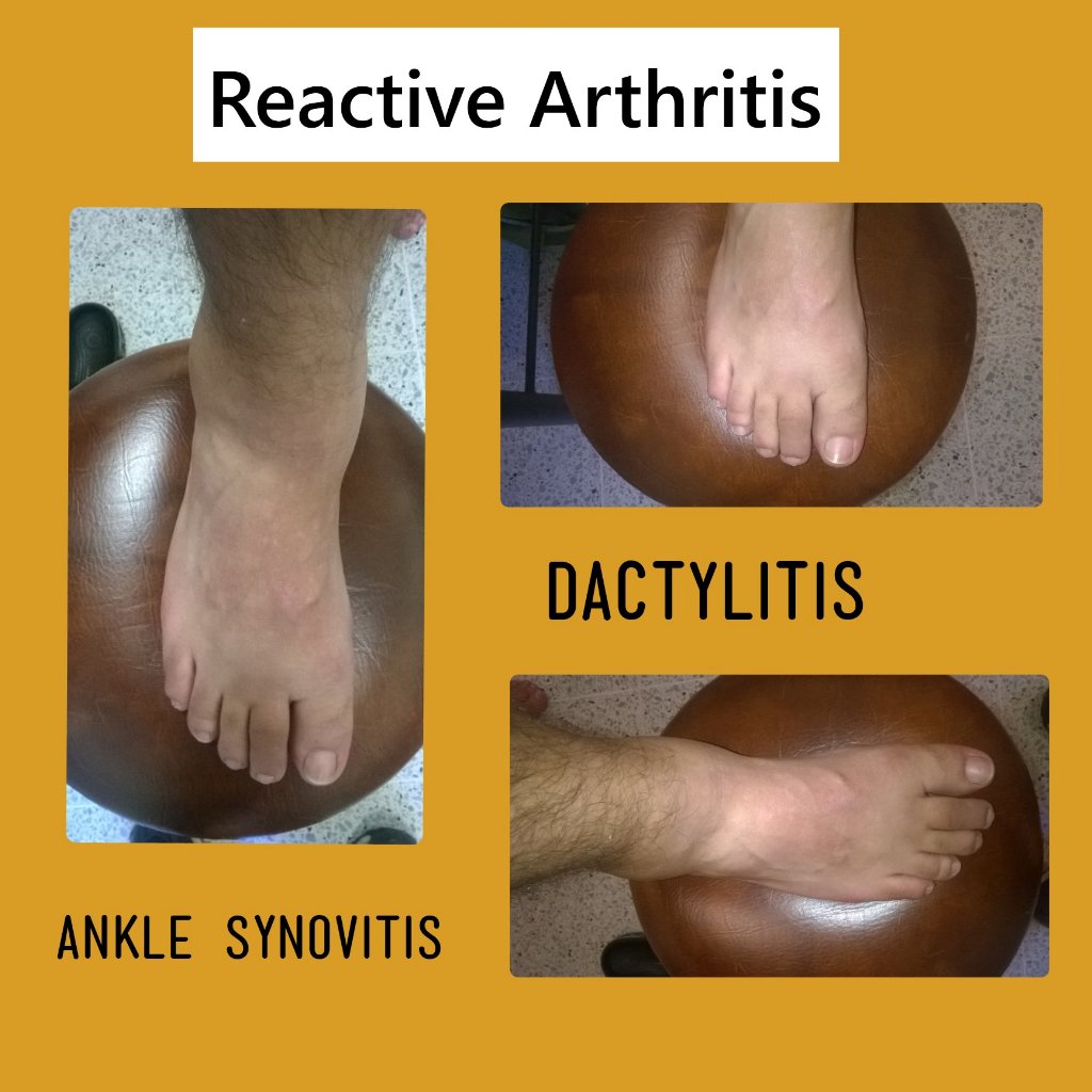 Reactive Arthritis