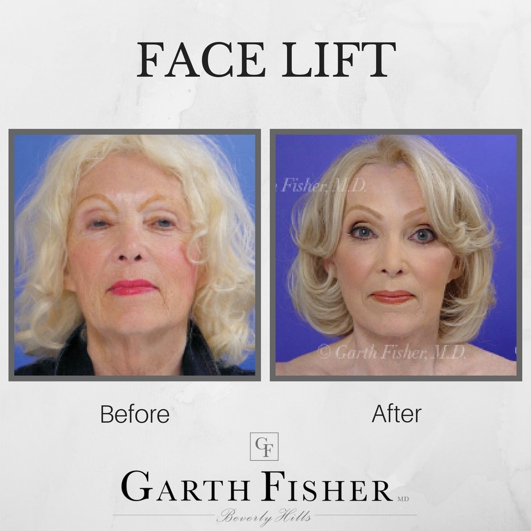 Garth Fisher Before And After