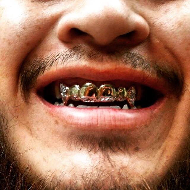 Permanent Gold Teeth