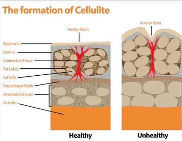 Cellulite Diagram