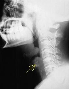 Epiglottitis Thumb Sign