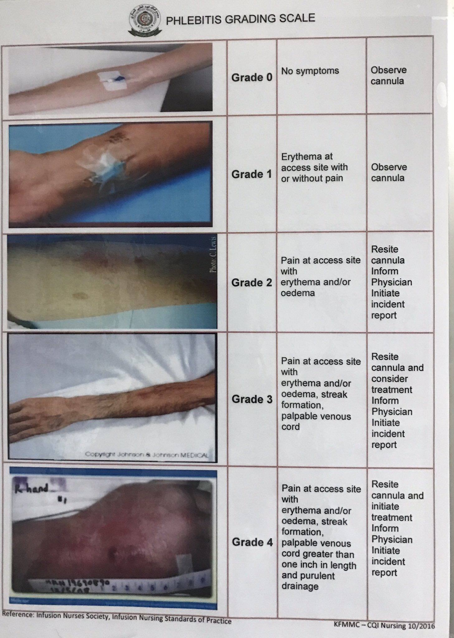 Infiltration Vs Phlebitis