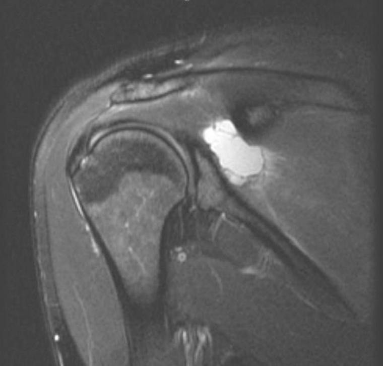 Suprascapular Notch Mri