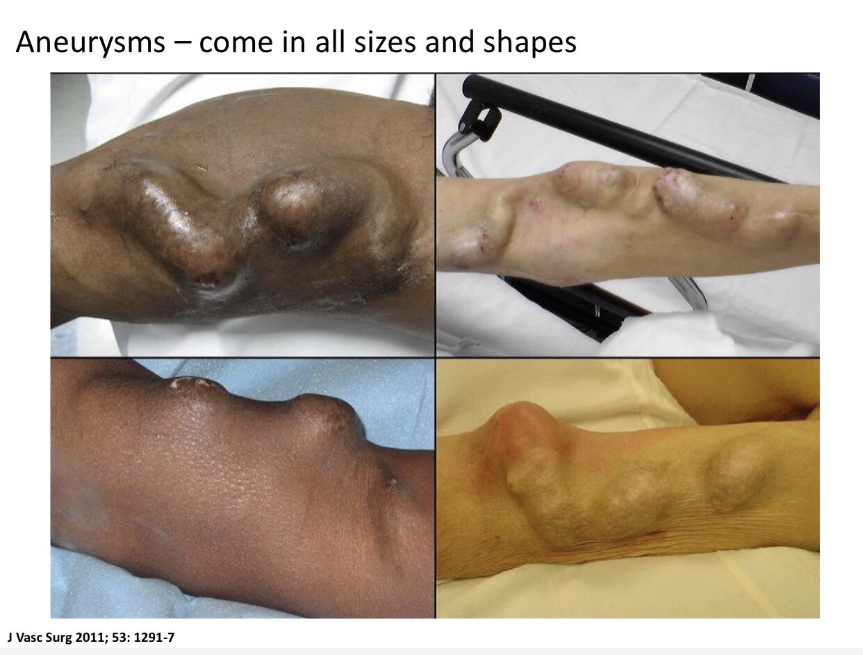 Pseudoaneurysm Av Fistula