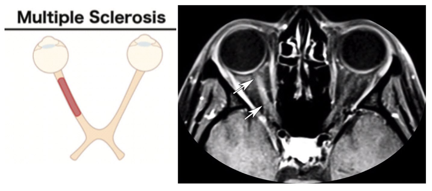 Optic Neuritis Multiple Sclerosis