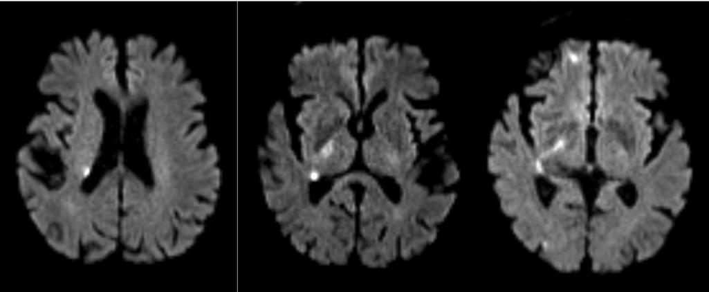 Posterior Limb Internal Capsule Stroke