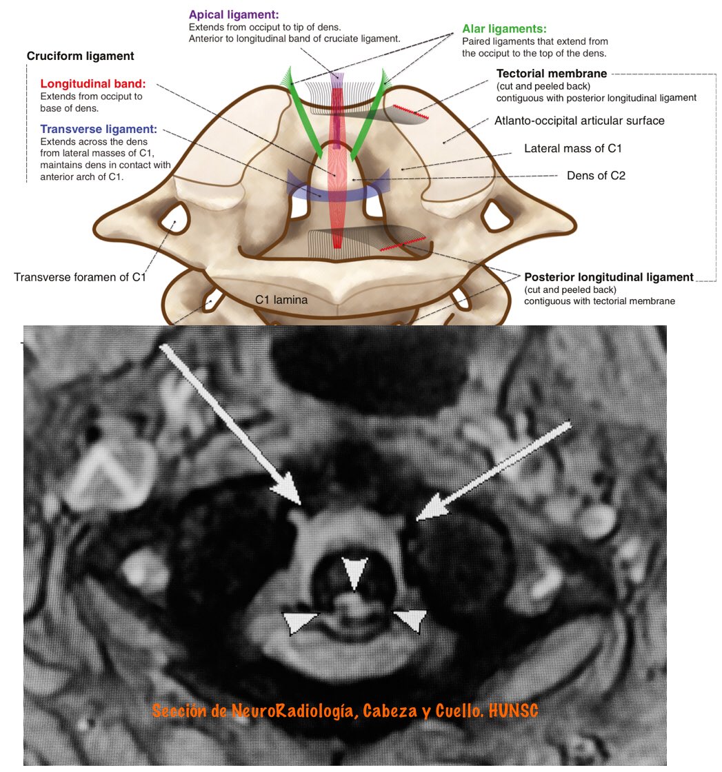 Apical Ligament Mri