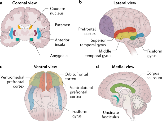 Pick's Disease Cortical Or Subcortical at Ilene Haase blog