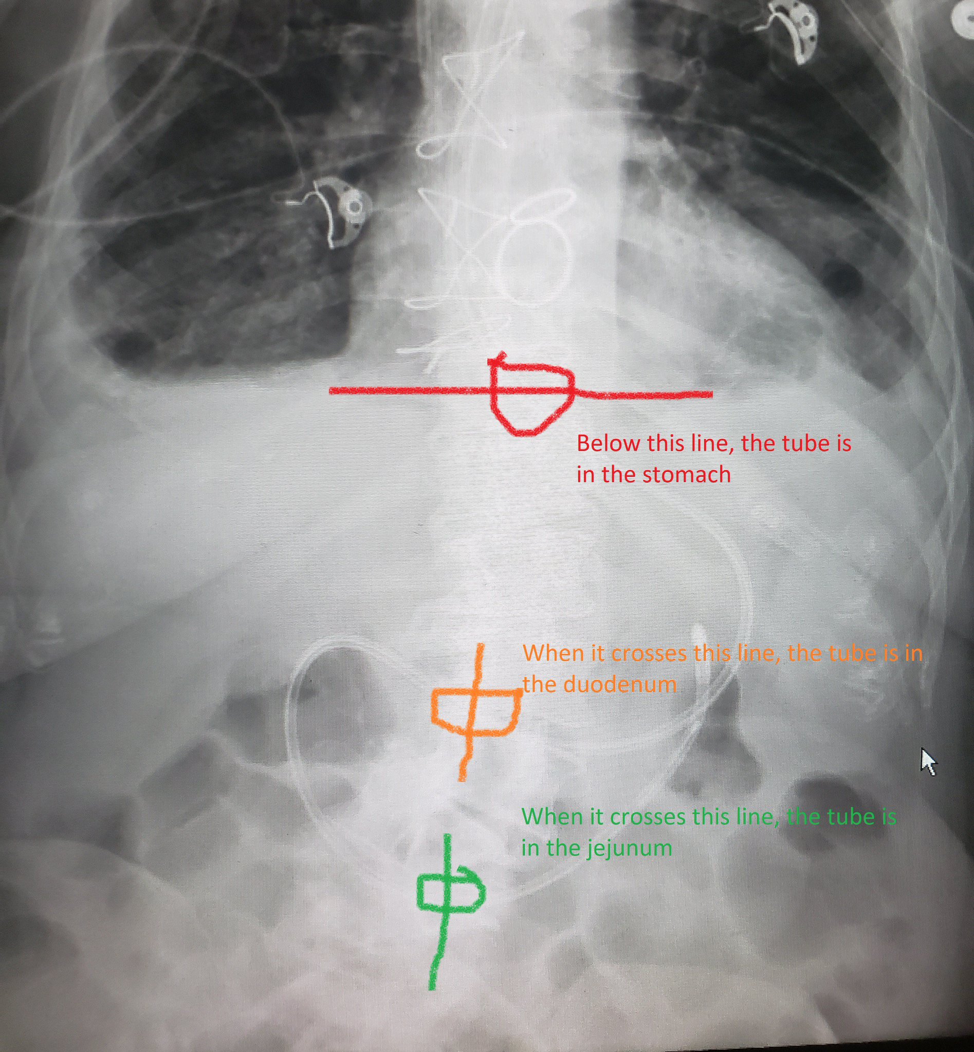Ligament Of Treitz X Ray Small Bowel Atresias: A Case Series With