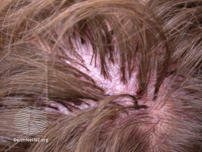 Multiple Hairs In One Follicle Multiple Hairs In One Follicle