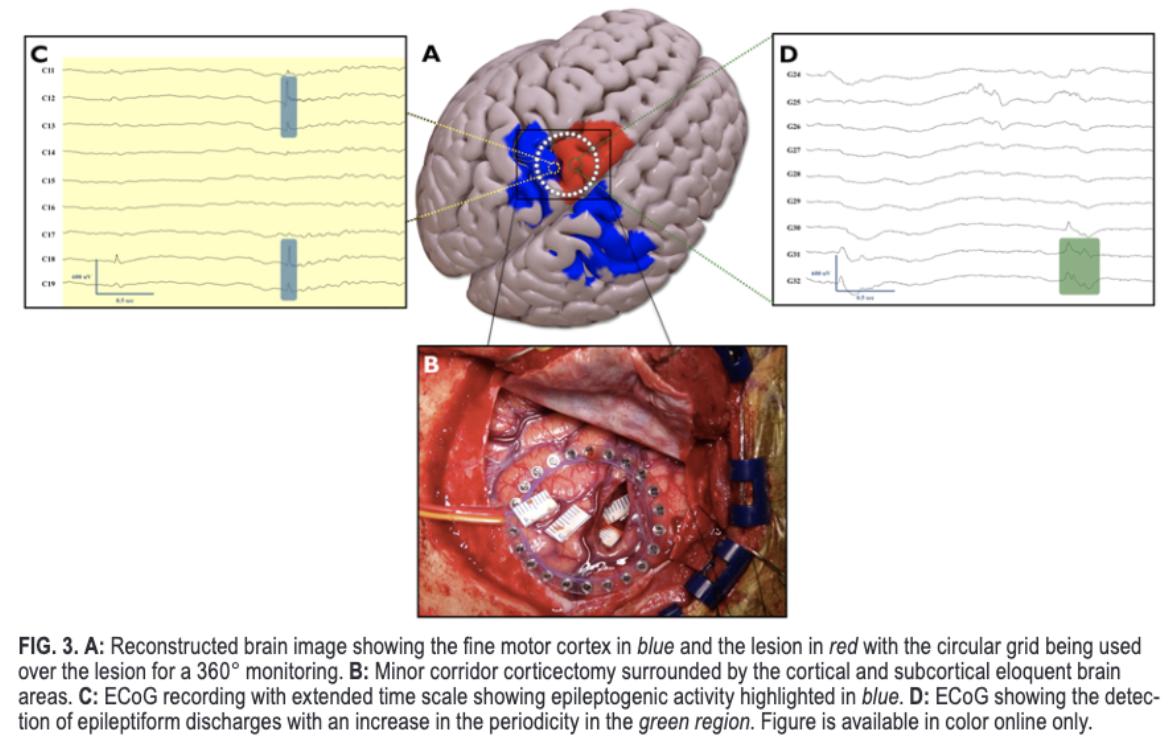 Journal of Neurosurgery on Twitter: "#OnlineFirst: A 360° electronic device for recording high ...