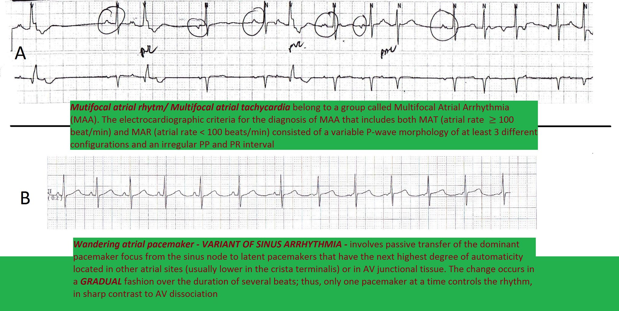Wandering Atrial Pacemaker Ecg