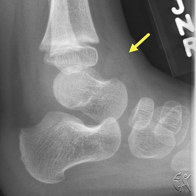Ankle Effusion X Ray