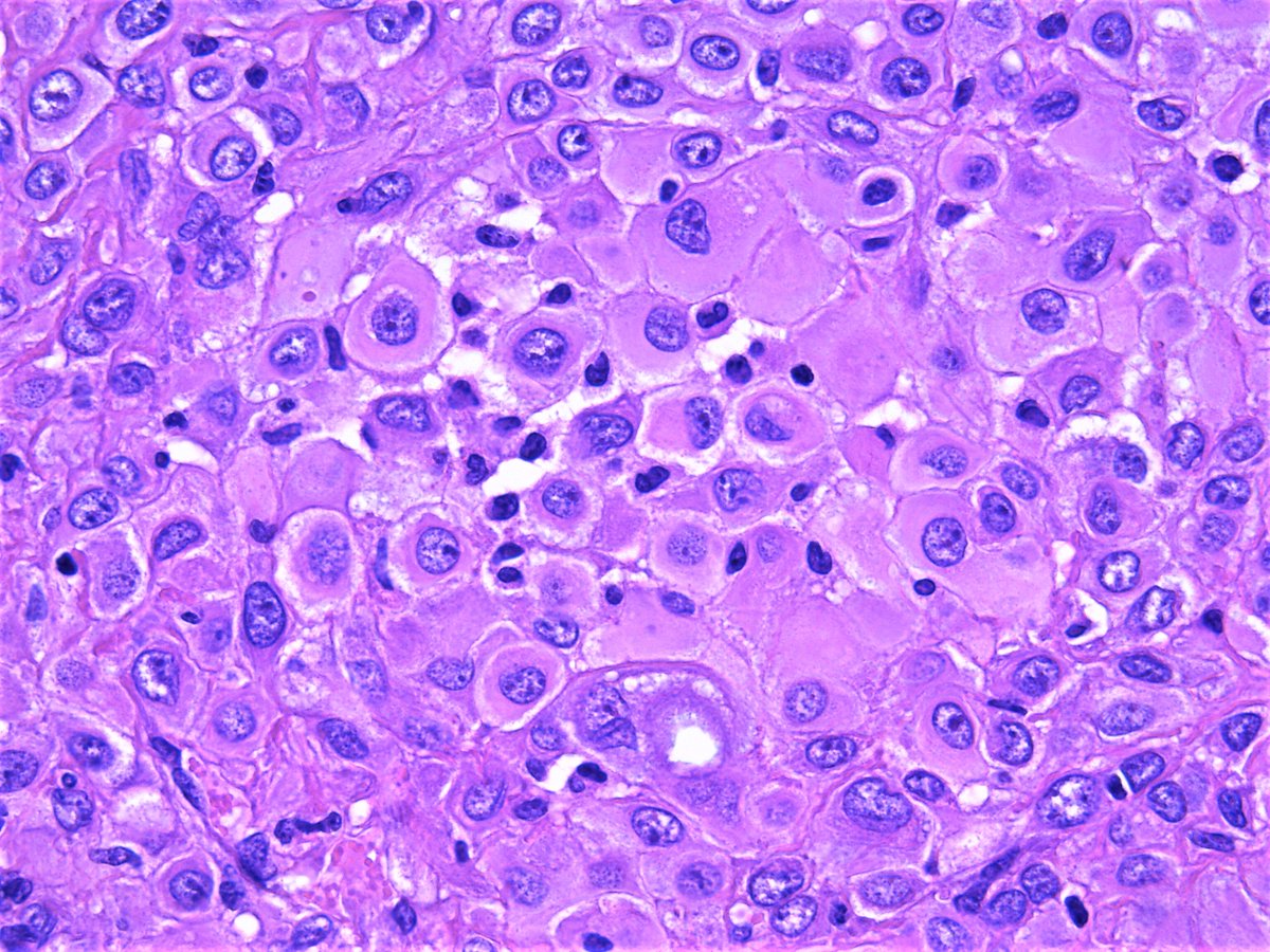 Pathology Walker@Auto Tweet Bot on Twitter: "Malignant mesothelioma, epithelioid type ...