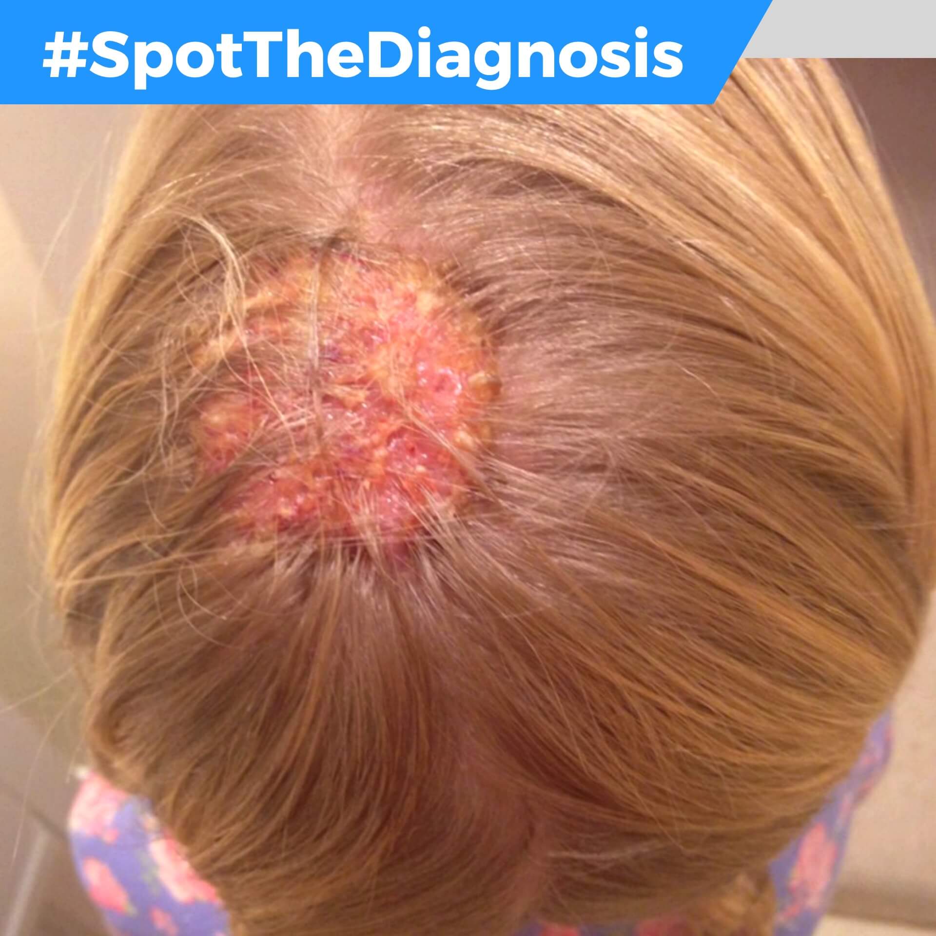 Pustular Psoriasis Scalp