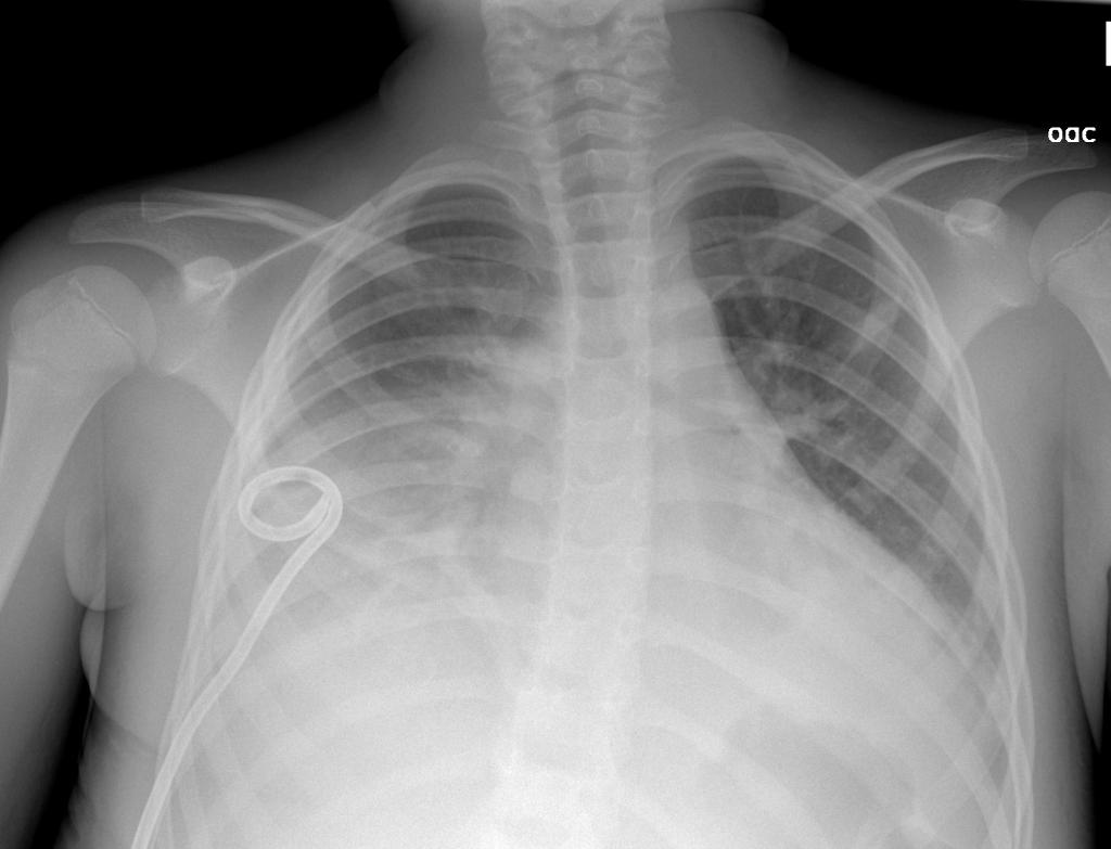 Pigtail Catheter Pleural Effusion