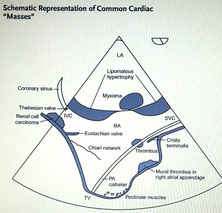 Crista Terminalis Echo