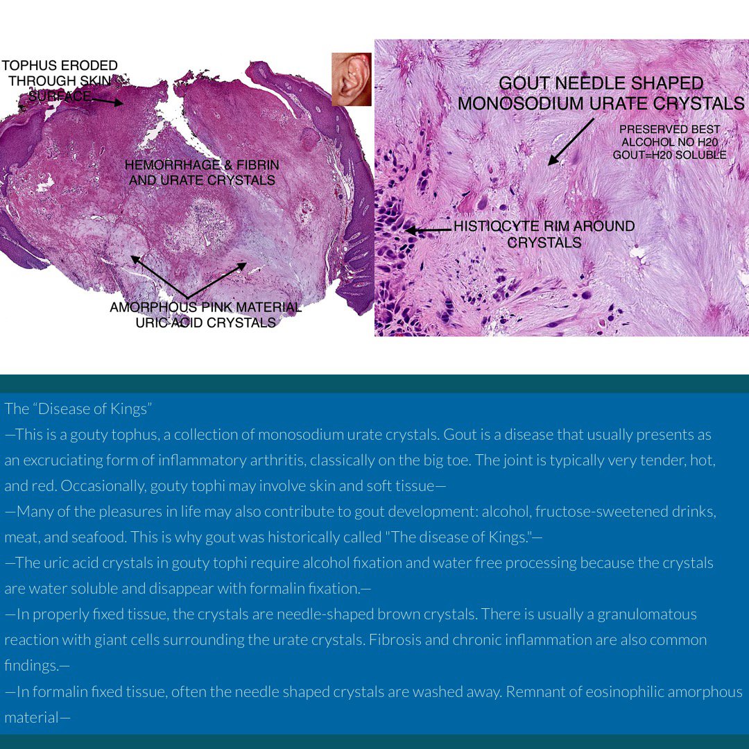Tophus Histology