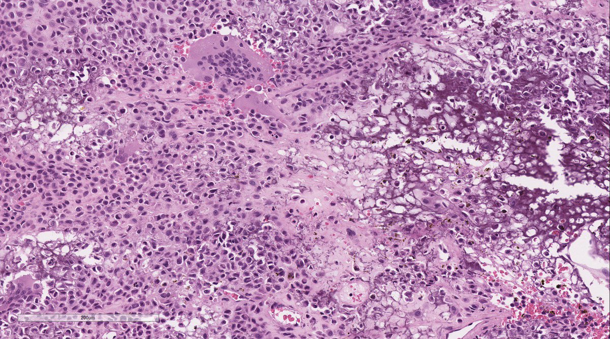 Chondroblastoma Chicken Wire