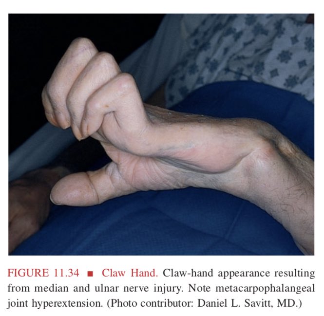 Ulnar Claw Hand
