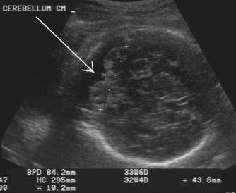 Cisterna Magna Ultrasound