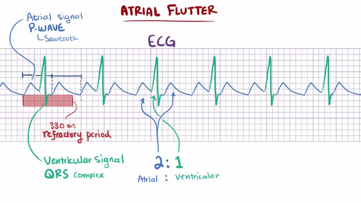 Sip compañera de clases Chelín flutter auricular ondas f guirnalda ...