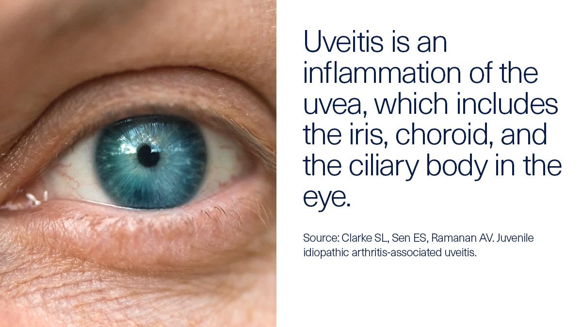 Uveitis In Kids Pediatric Uveitis Specialists In North Texas Fort