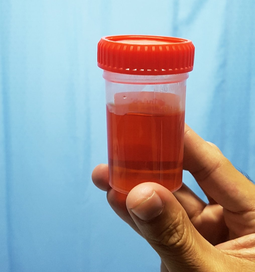 Red Urine