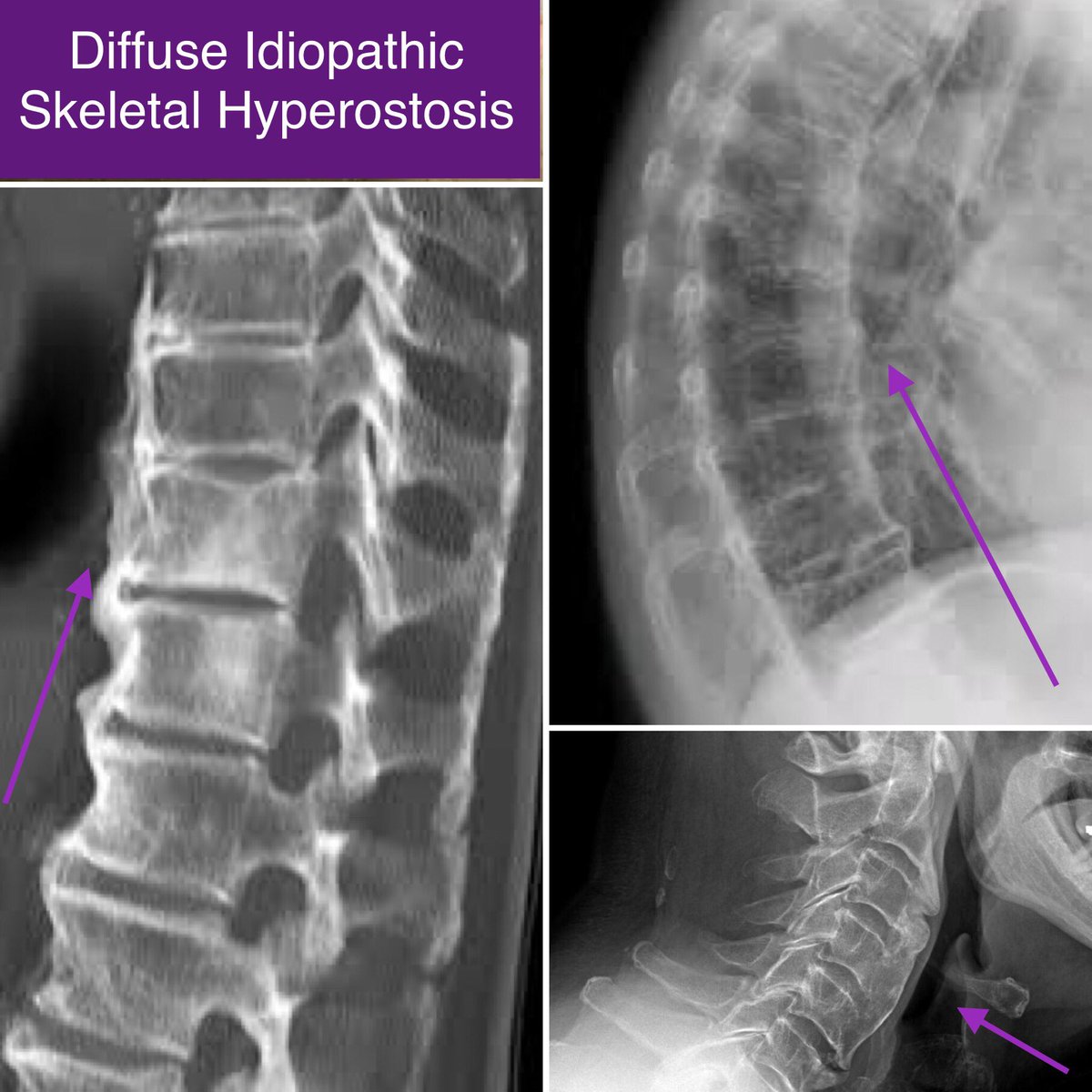Non Marginal Syndesmophytes