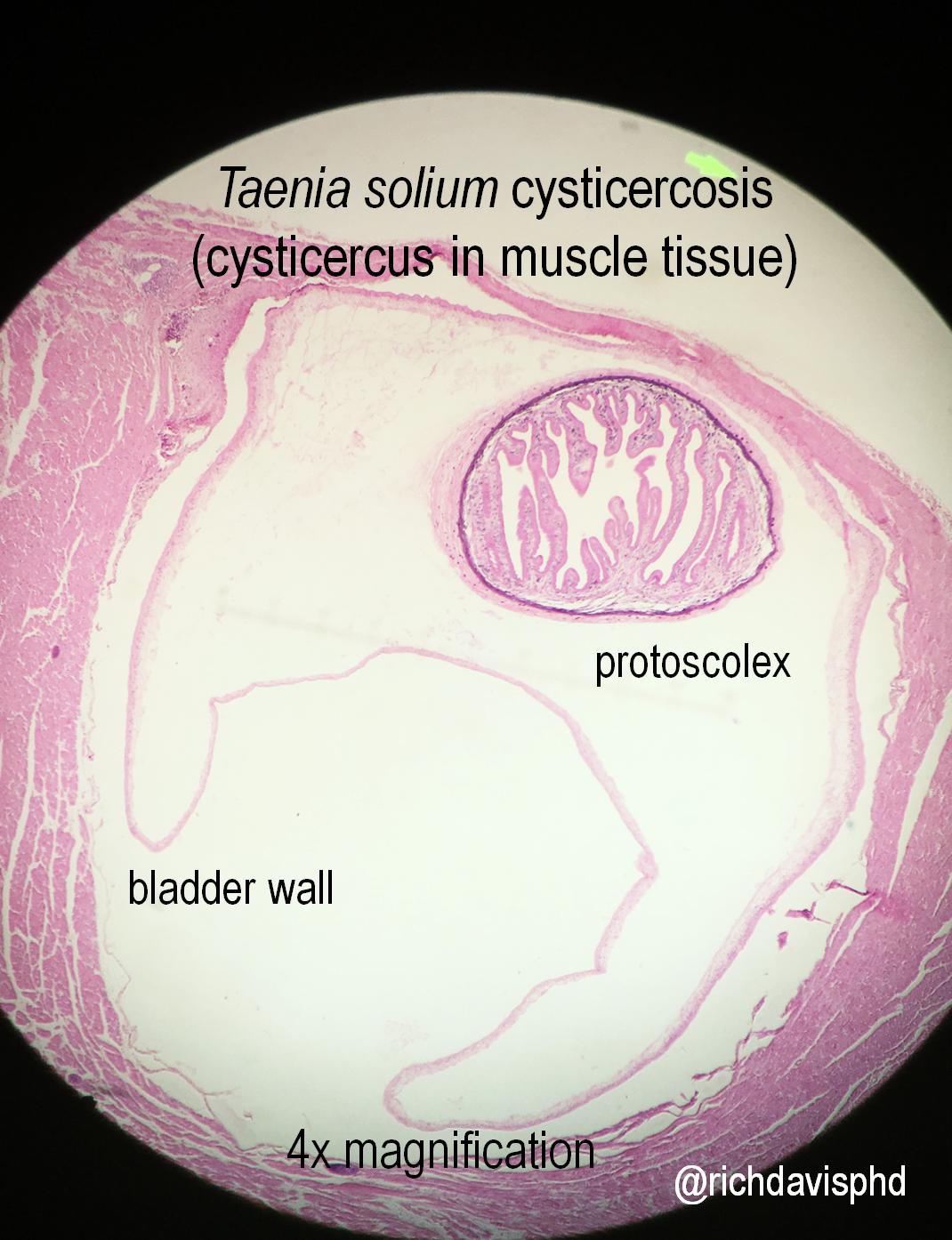 Taenia Solium Cysticercus Diagram
