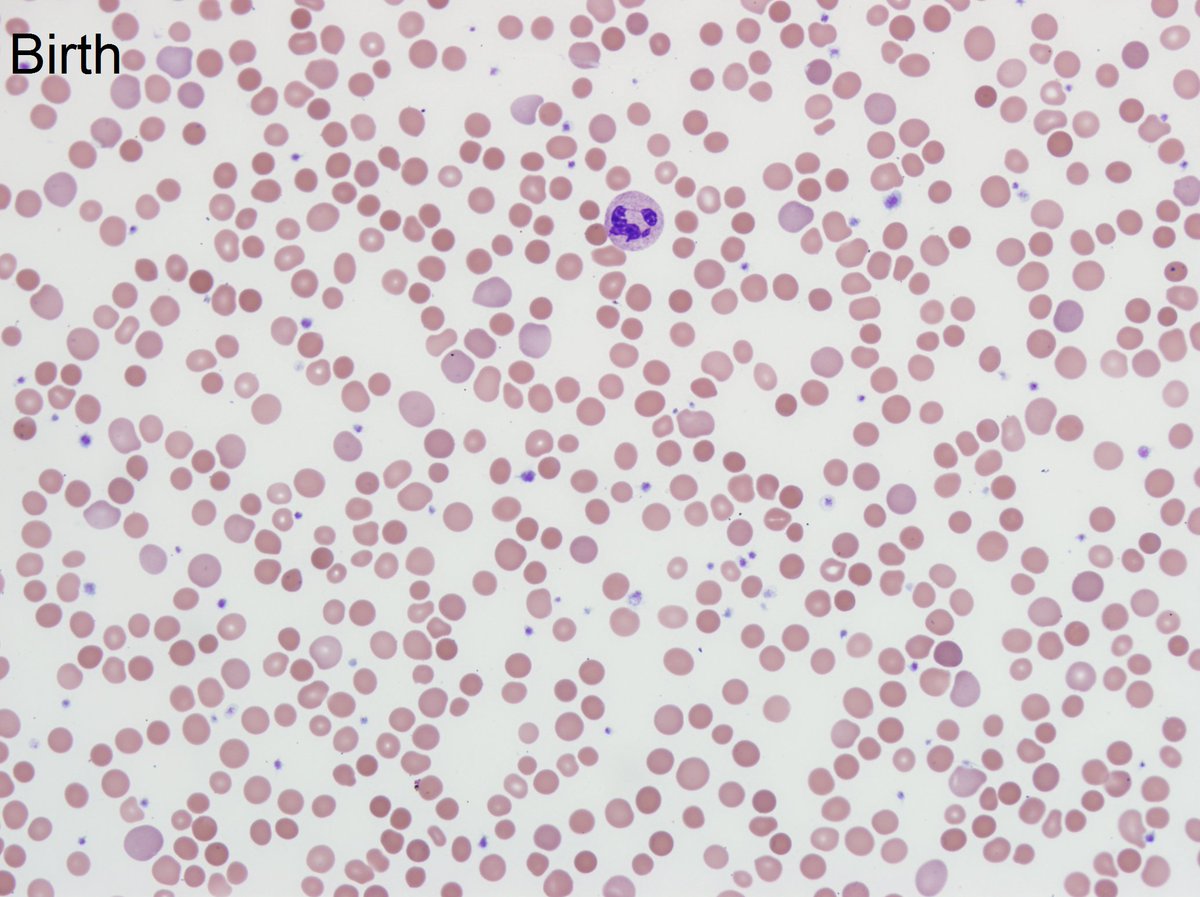 Spherocytosis And Hereditary Spherocytosis Causes
