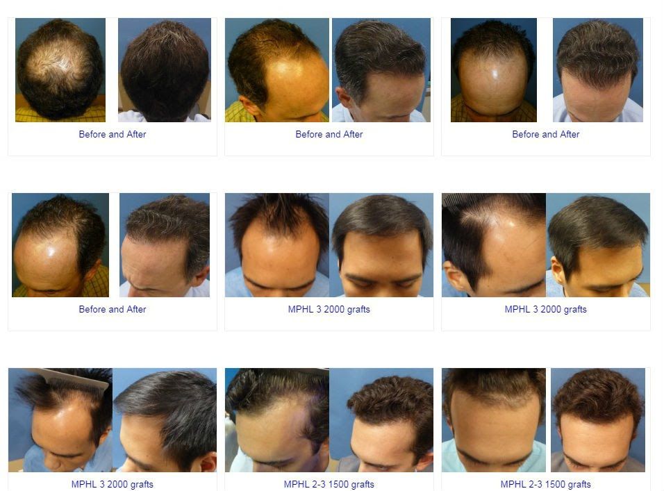 Top 153 Hair Restoration Los Angeles Ca Polarrunningexpeditions