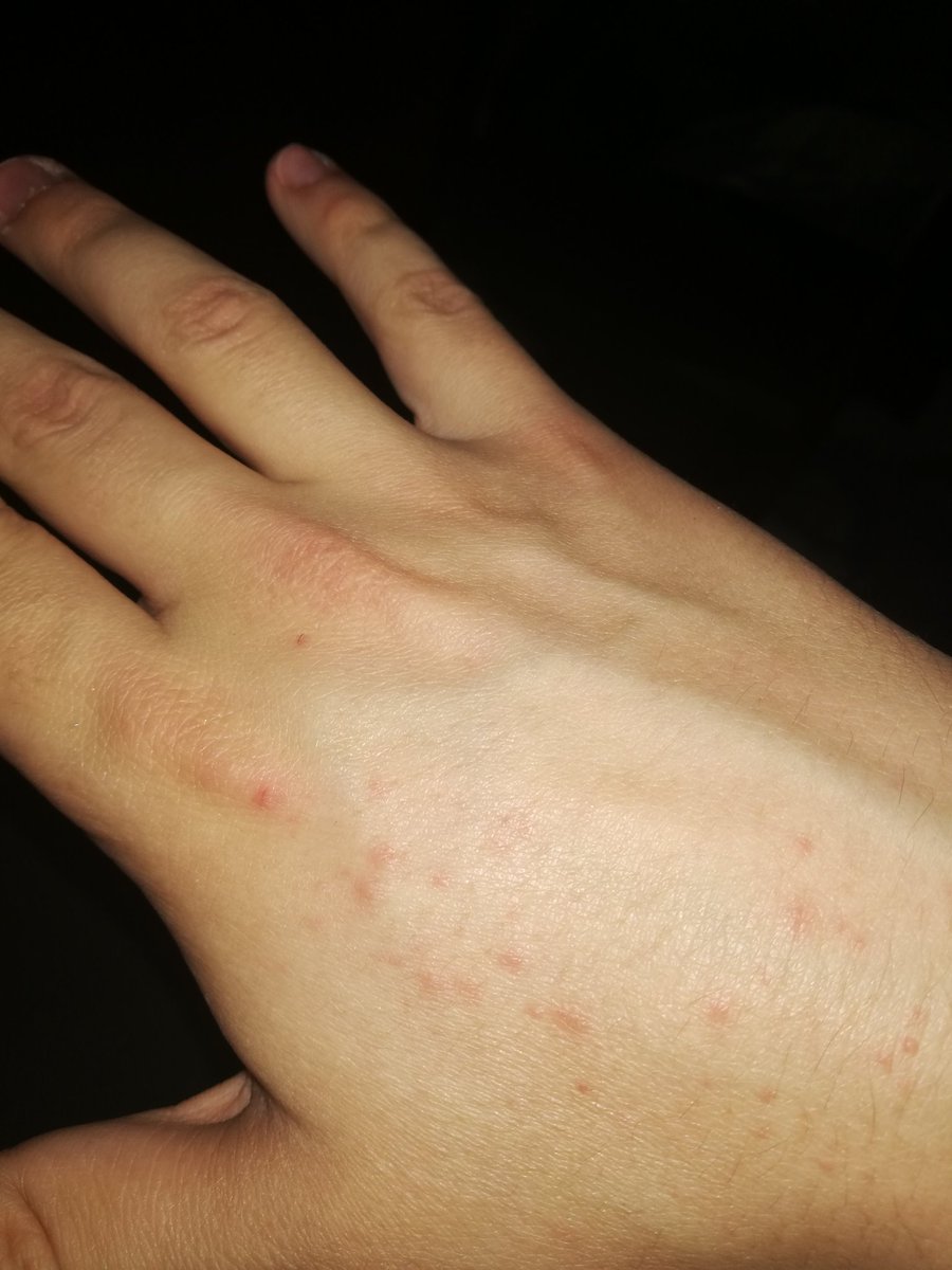 Me han salido estos granos en las manos +médicosamí - Forocoches