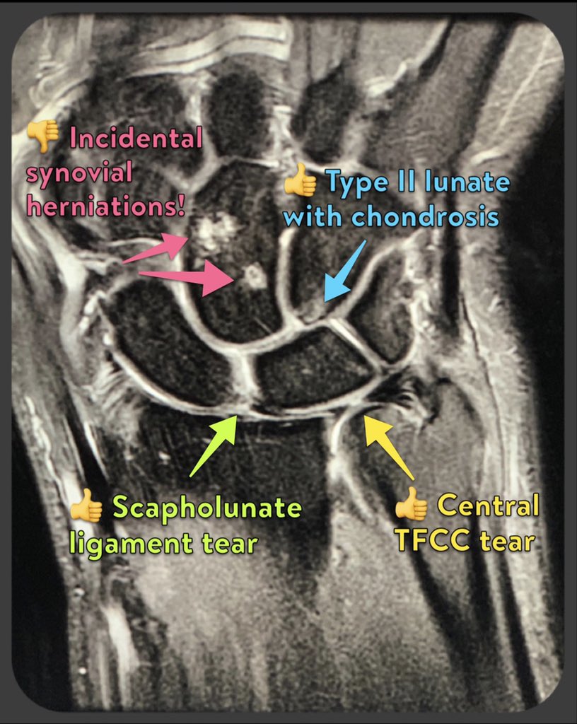 Wrist Ligaments Mri